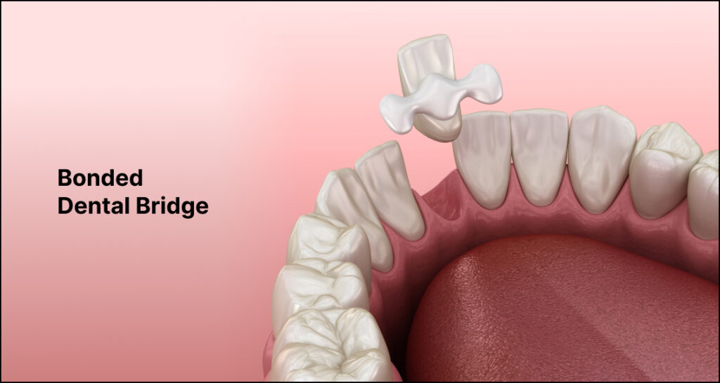 How Much Does A Dental Bridge Cost Without Insurance?