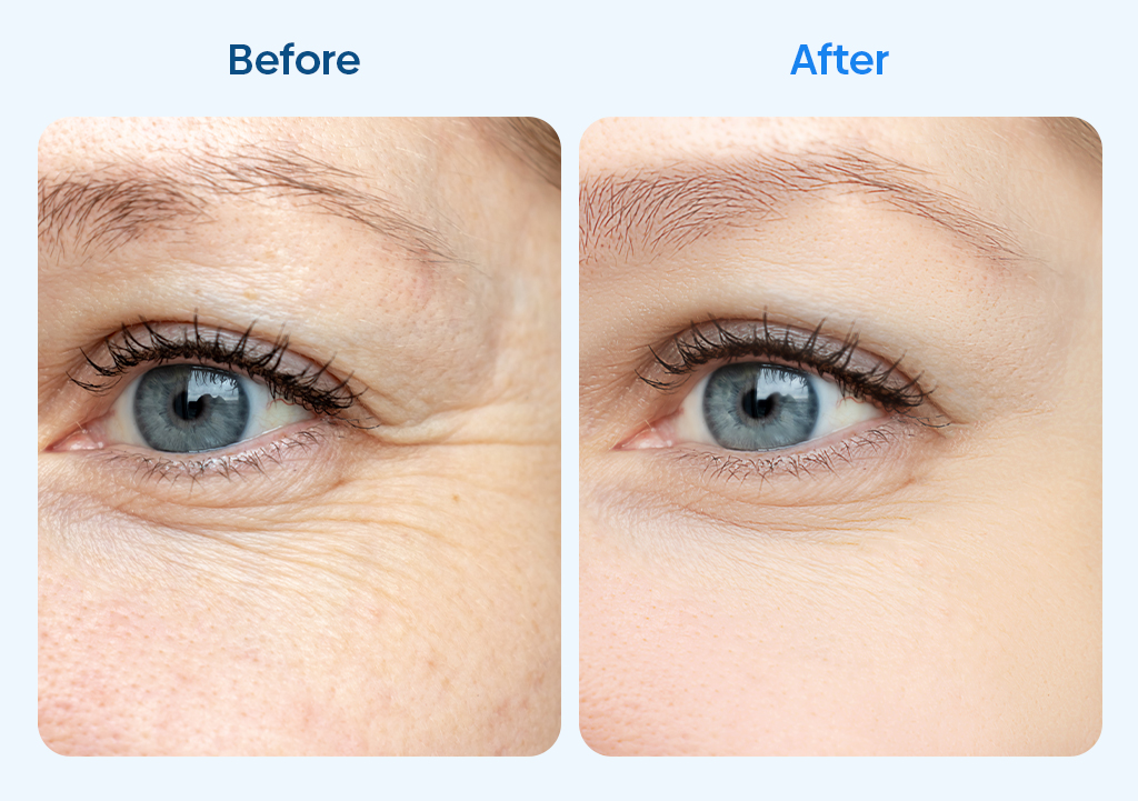 Daxxify vs Botox: Is the Newer Treatment Really Worth It?